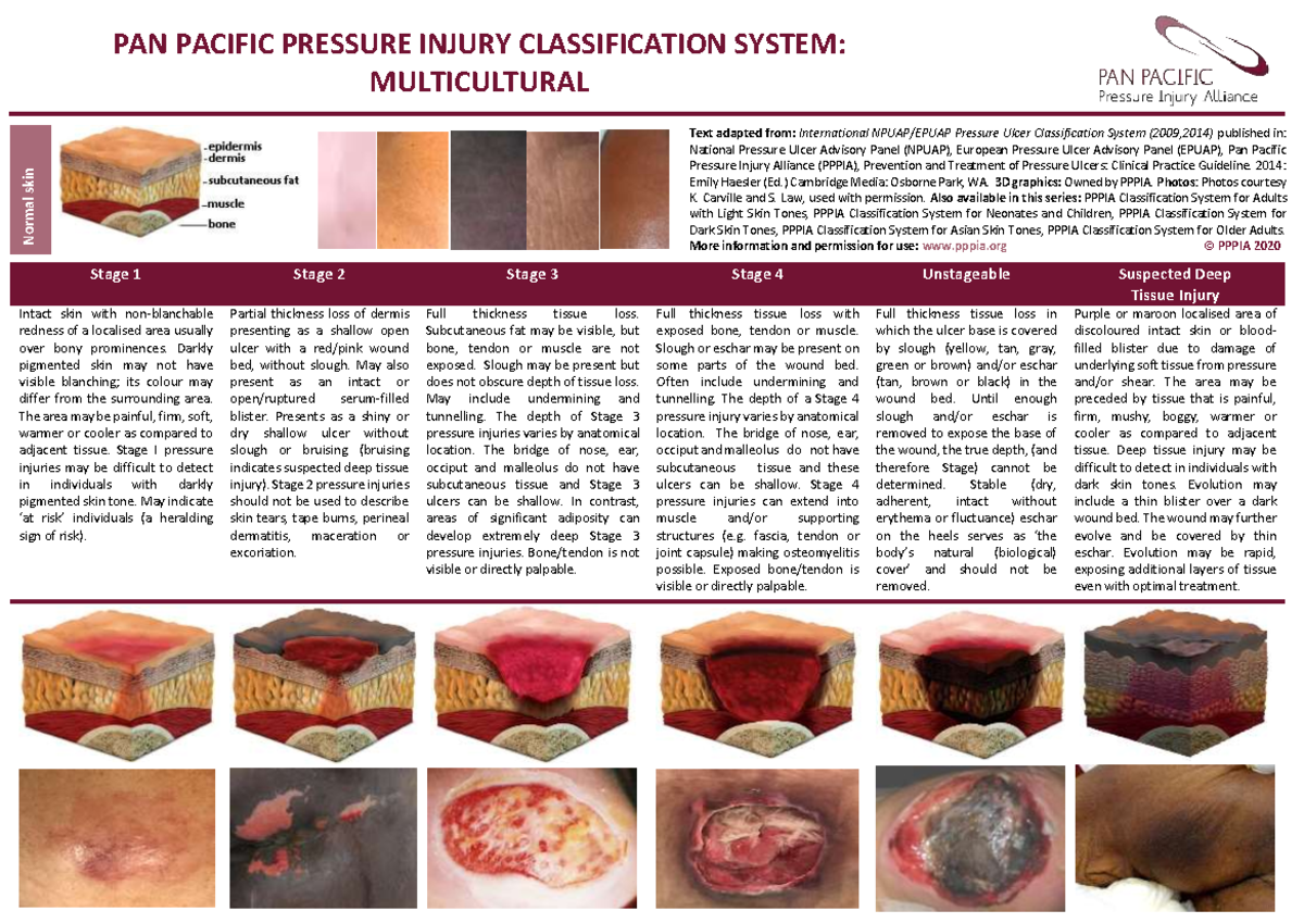 Pan Pacific Pressure Injury Classification System: Multicultural ...