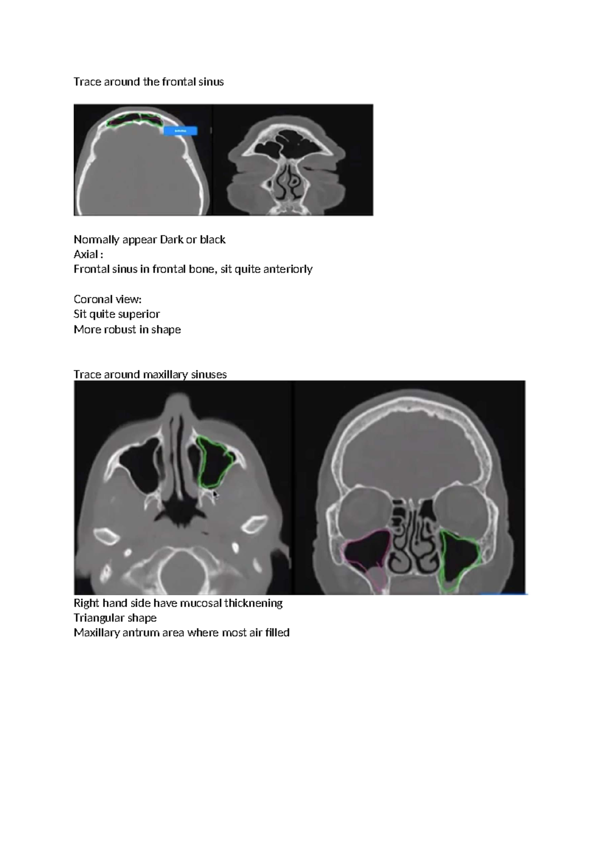 Sinuses tut (mrsc cross section) - Trace around the frontal sinus ...