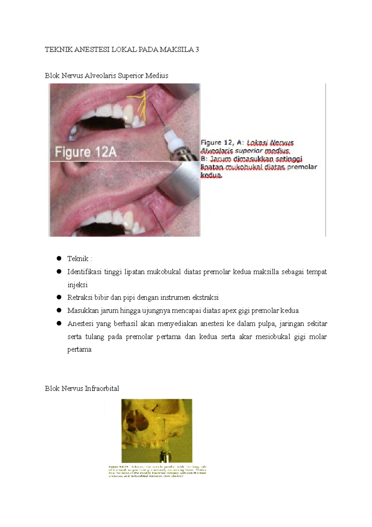Teknik Anestesi Lokal pada Maksila: Blok Nervus Alveolaris ...