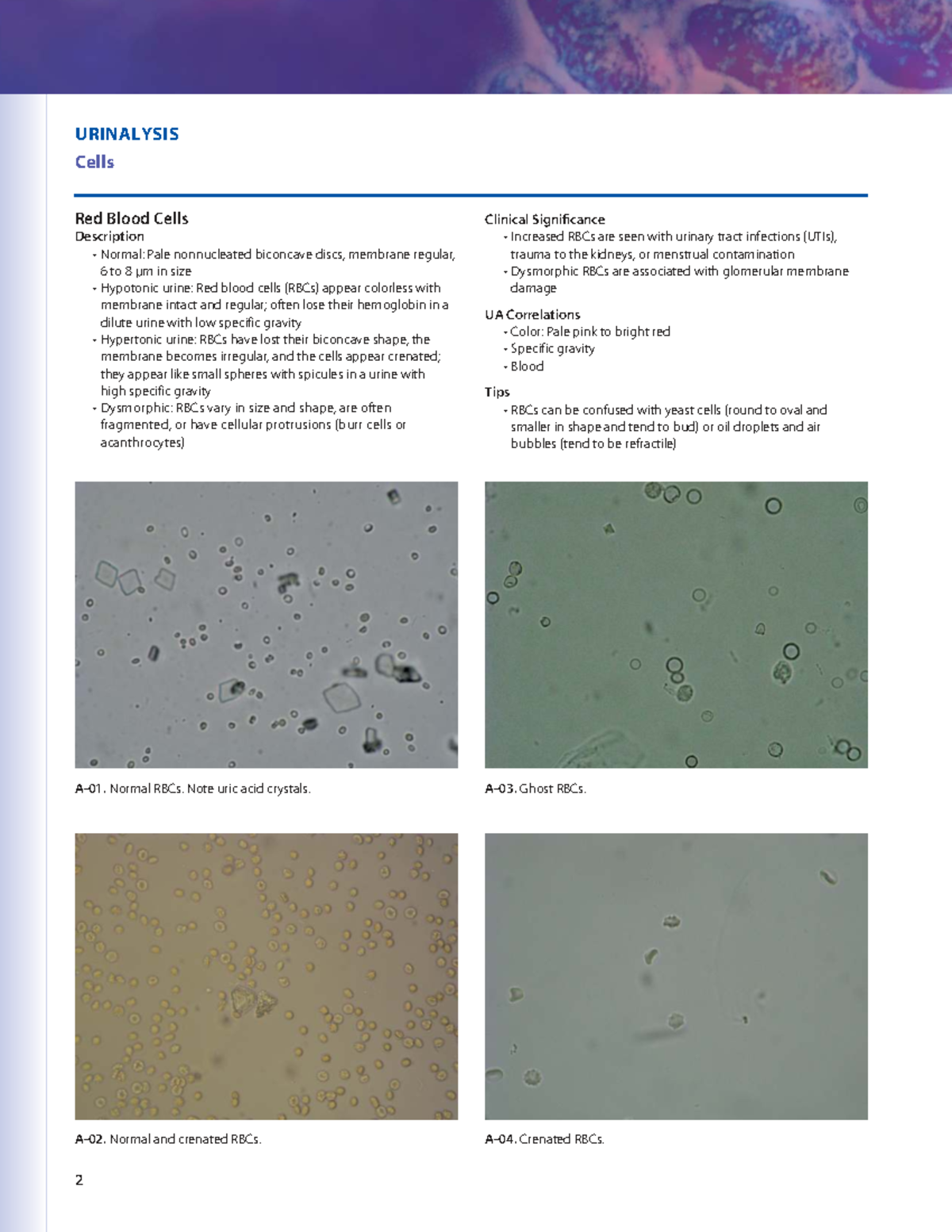 URINALYSIS: Red Blood Cells, White Blood Cells, and Casts Overview ...