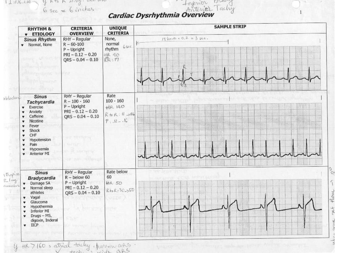 Cardiac Dysrhythmia Overview: EKG Rhythm Criteria & Etiology Analysis ...