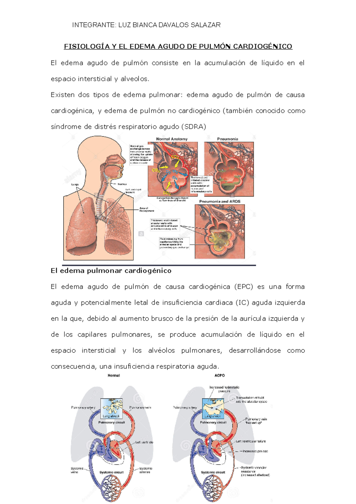 Fisiología del Edema Agudo de Pulmón Cardiogénico: Análisis y ...