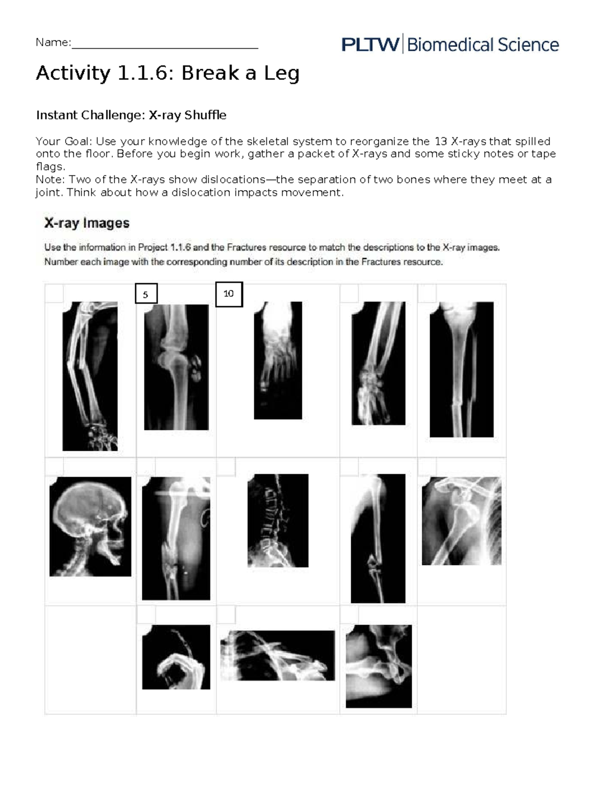Activity 1.1.6: Understanding Bone Fractures and Healing - Studocu