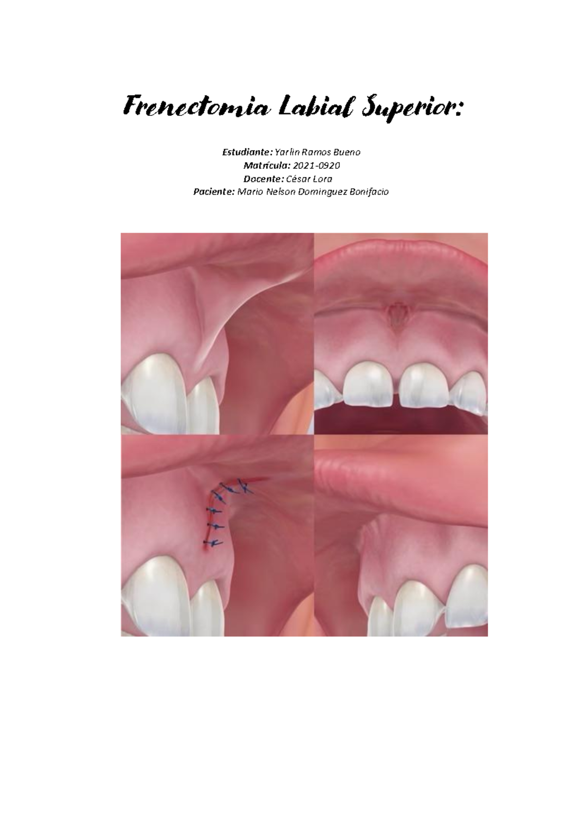 Protocolo de Frenectomía Labial Superior - Estudiante 2021-0920 - Studocu