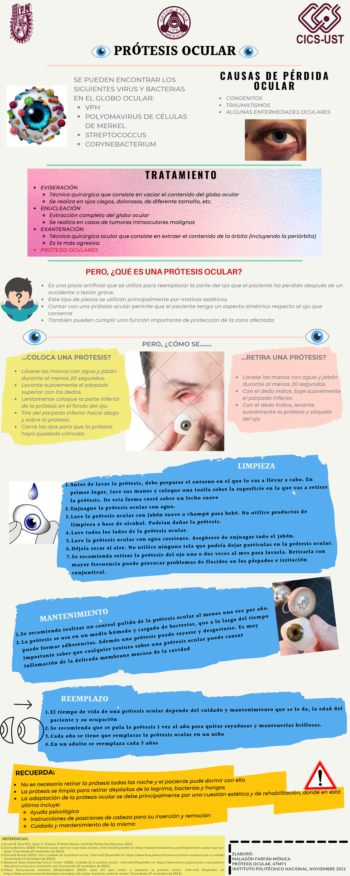 Infografía Prótesis Ocular: ¿qué es una prótesis ocular? - T R A T A M ...