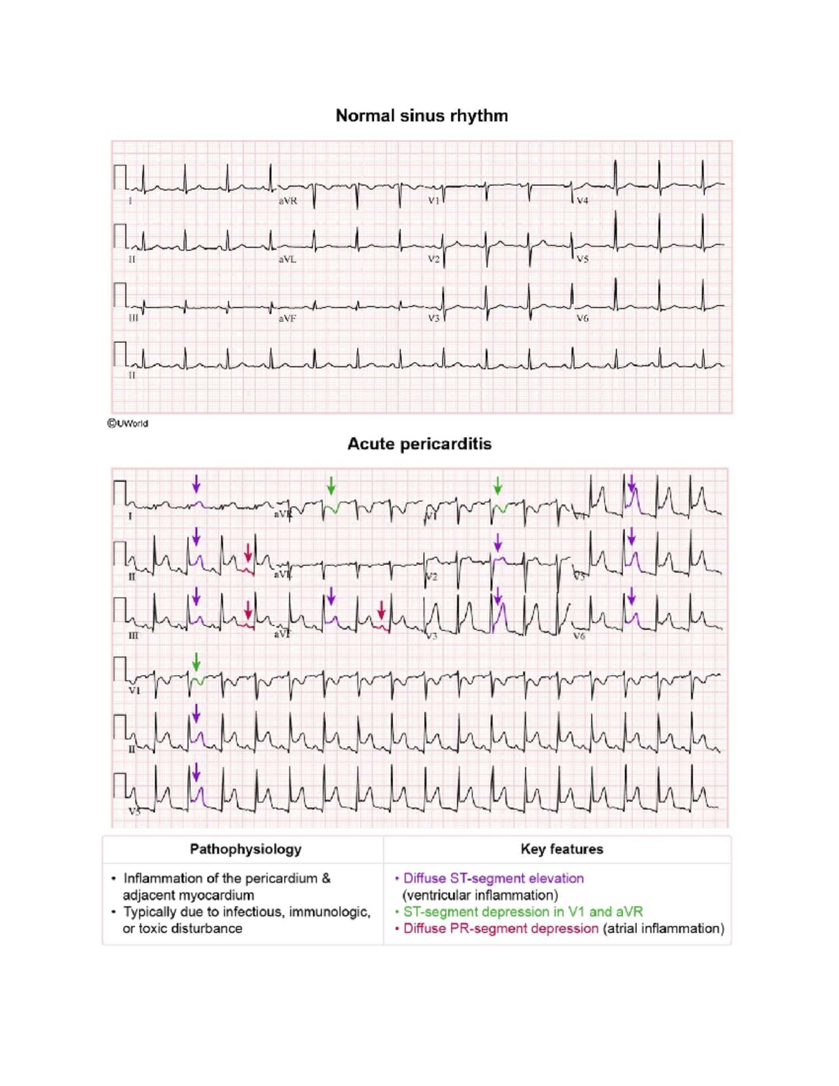 ECG - Electrocardiogram Analysis: Acute Pericarditis & STEMI Insights ...