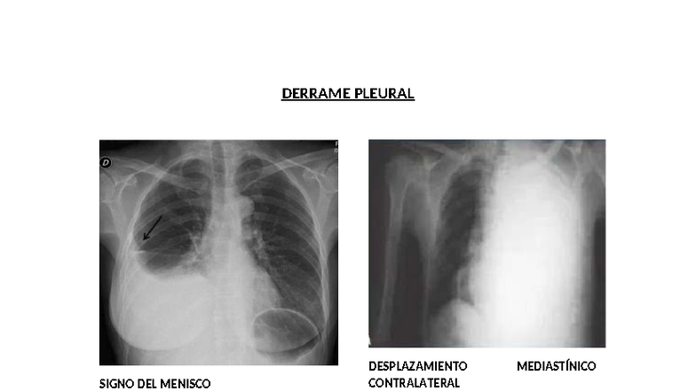 DERRAME PLEURAL: Signos Radiológicos y Diagnóstico (Rx) - Studocu
