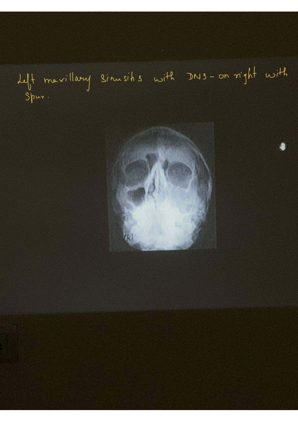 ENT X-RAY - Good - Left marillary Sinusihs with DNS on night with Spur ...
