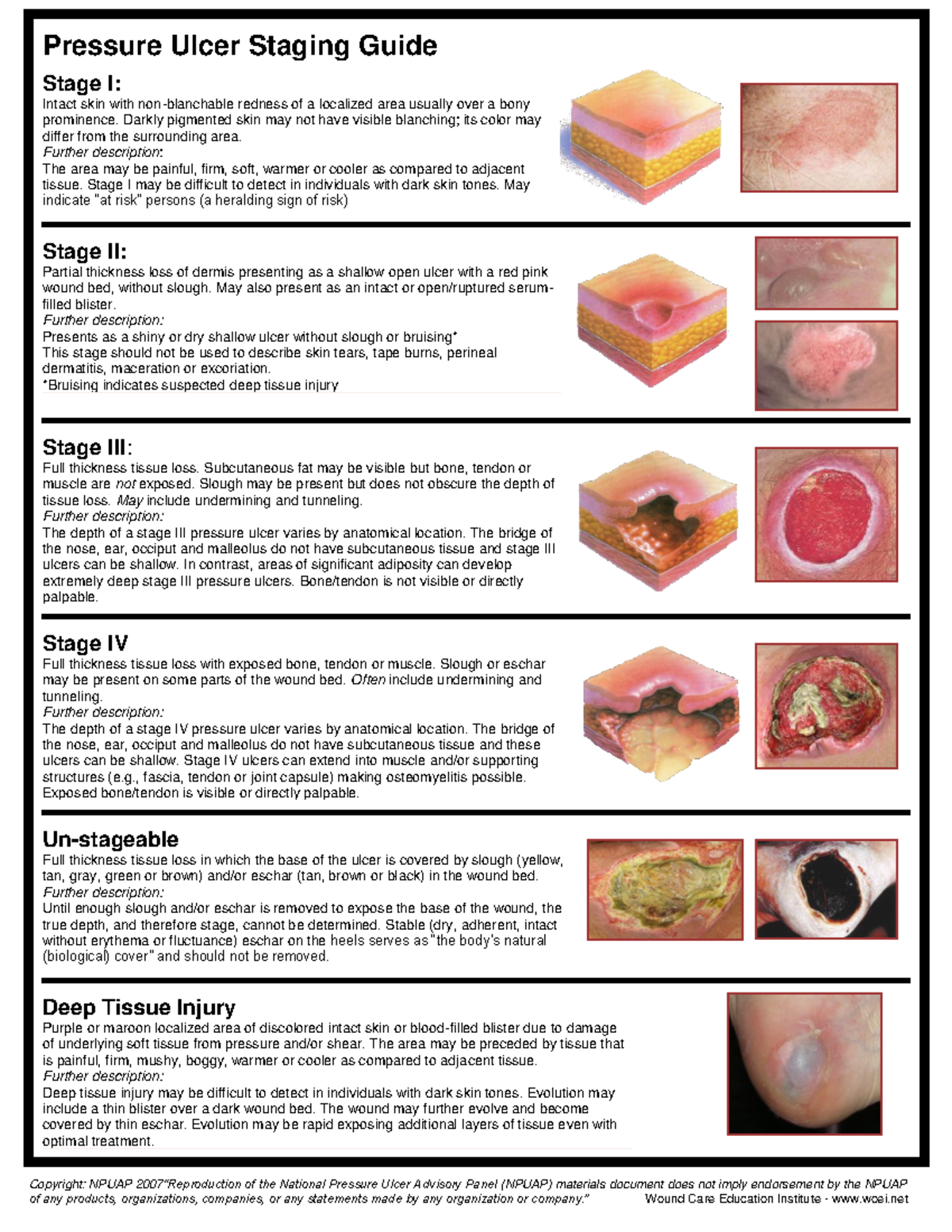 CNUR 101 pressure ulcer - Stage I: Intact skin with non-blanchable ...