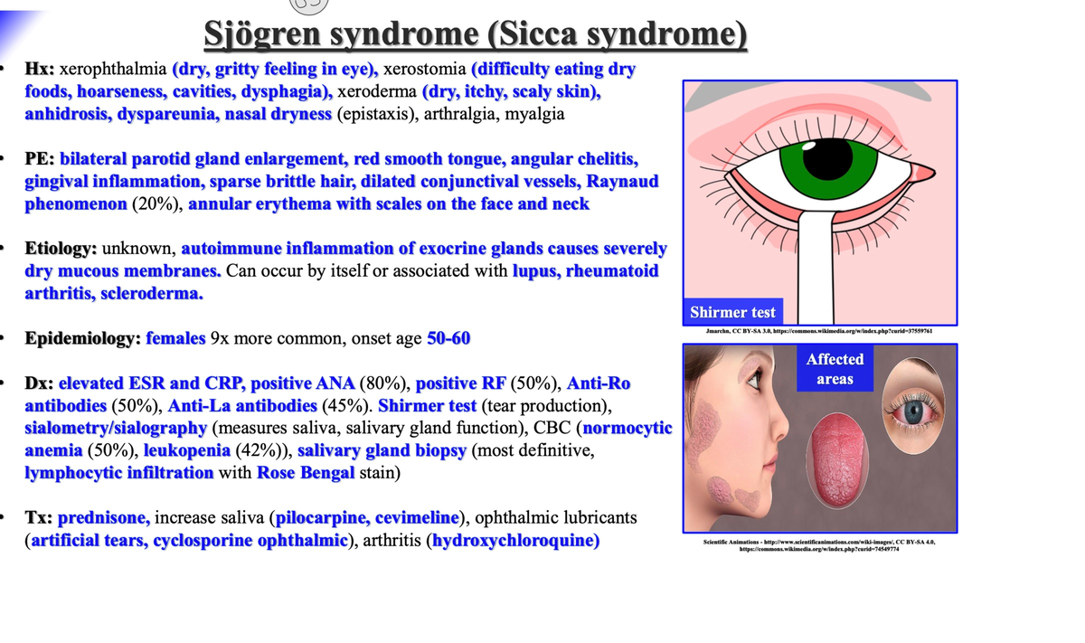 Screenshot 2025-01-11 at 9.39.38 PM - Sjögren syndrome (Sicca syndrome ...