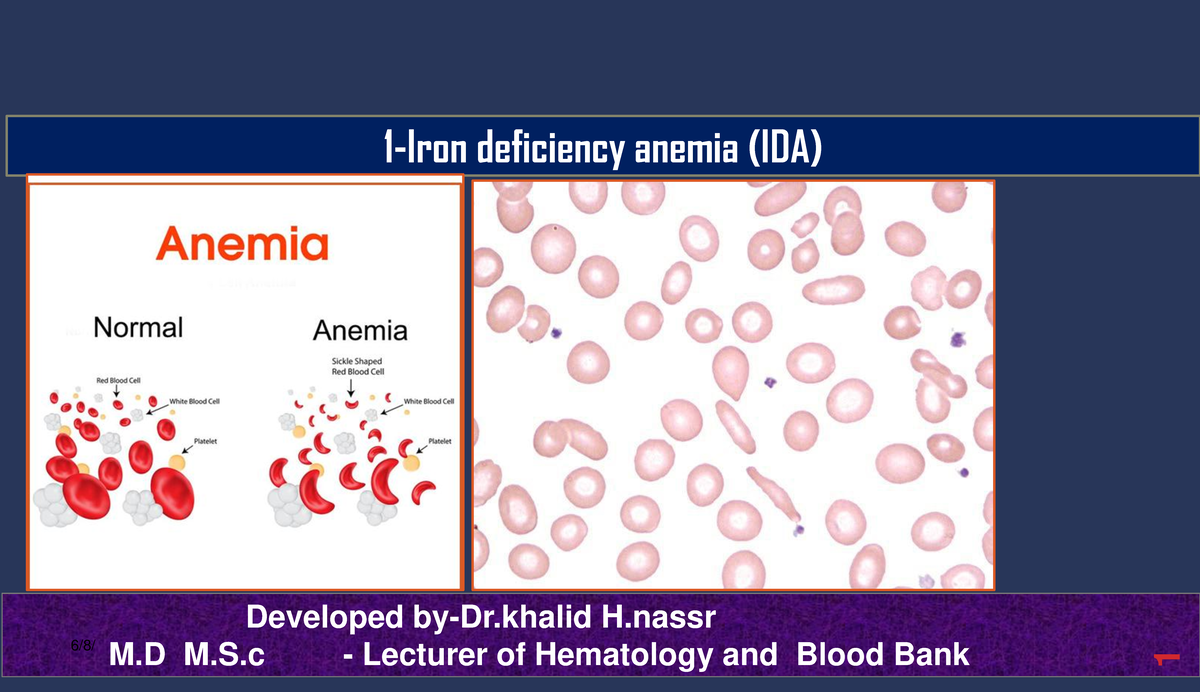 Iron Deficiency Anemia (IDA) Overview and Diagnosis - Studocu