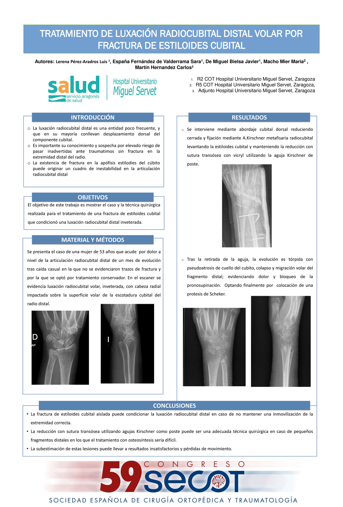 Tratamiento Quirúrgico de Luxación Radiocubital Distal por Fractura COT ...