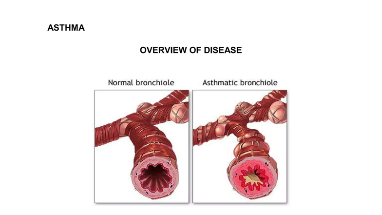 ASTHMA 101: Overview, Pathophysiology, and Nursing Interventions - Studocu
