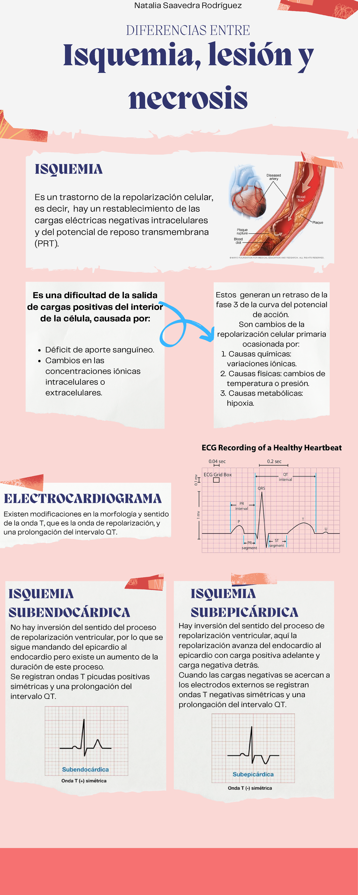 Diferencias entre Isquemia, Lesión y Necrosis en EKG - Análisis ...