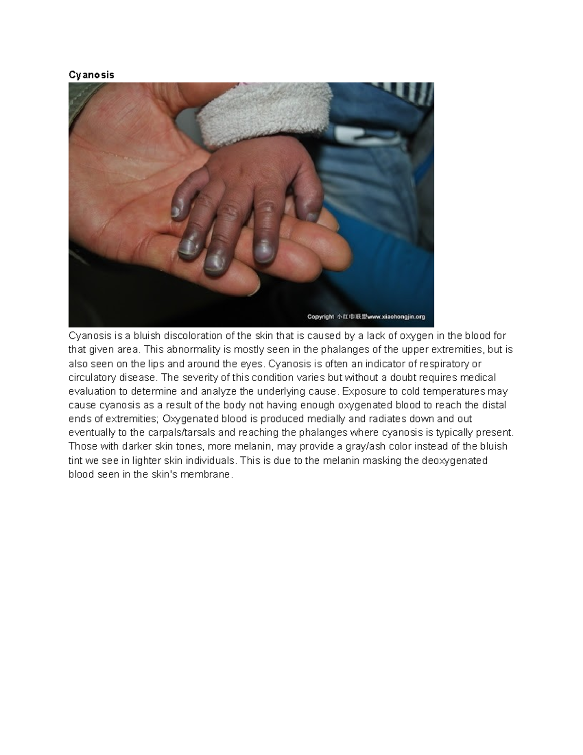 Cyanosis: Understanding Causes, Symptoms, and Implications - Studocu