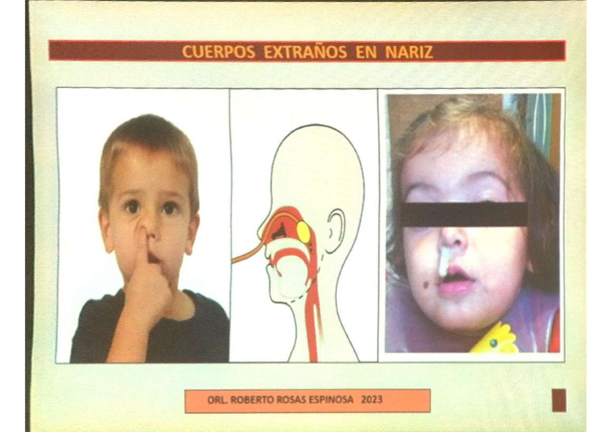 Cuerpos Extraños en Nariz: Diagnóstico y Manejo ORL 2023 - Studocu