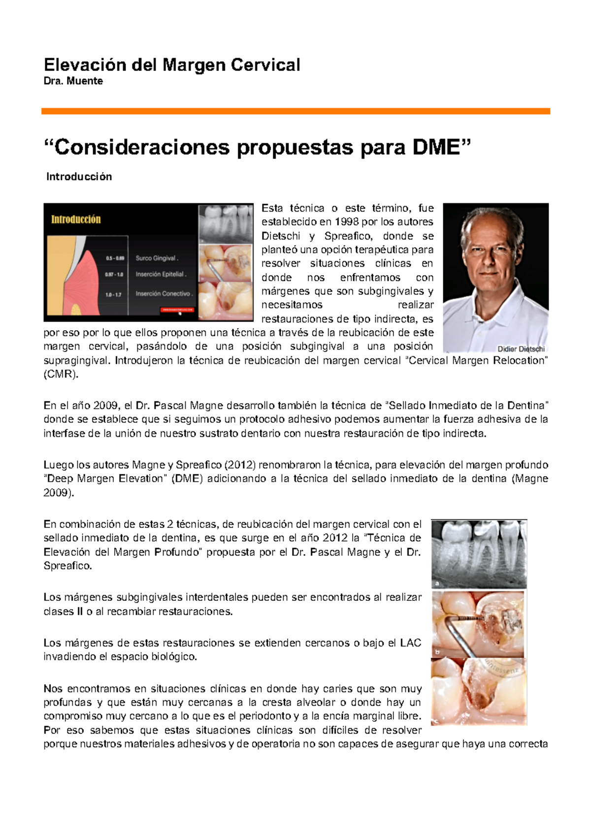 Técnica de Elevación del Margen Cervical (DME) - Consideraciones Clave ...