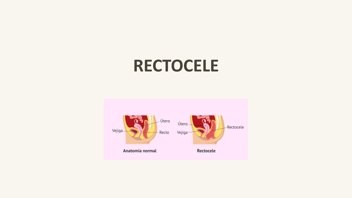 Estudio sobre Rectocele: Síntomas, Diagnóstico y Tratamiento - Studocu