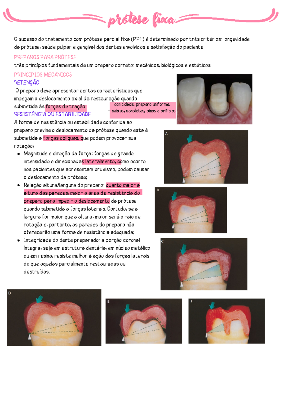 Protocolo Clínico para Prótese Fixa: Aspectos e Técnicas Essenciais ...