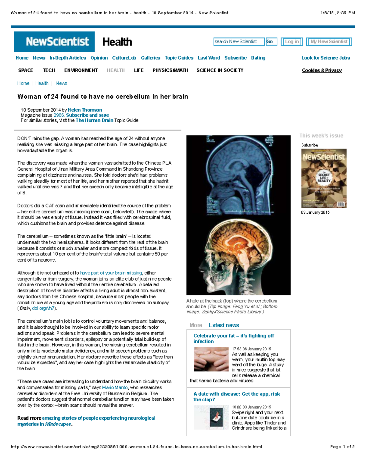 Women of 24 Living Without Cerebellum: A Case Study Insights - Studocu