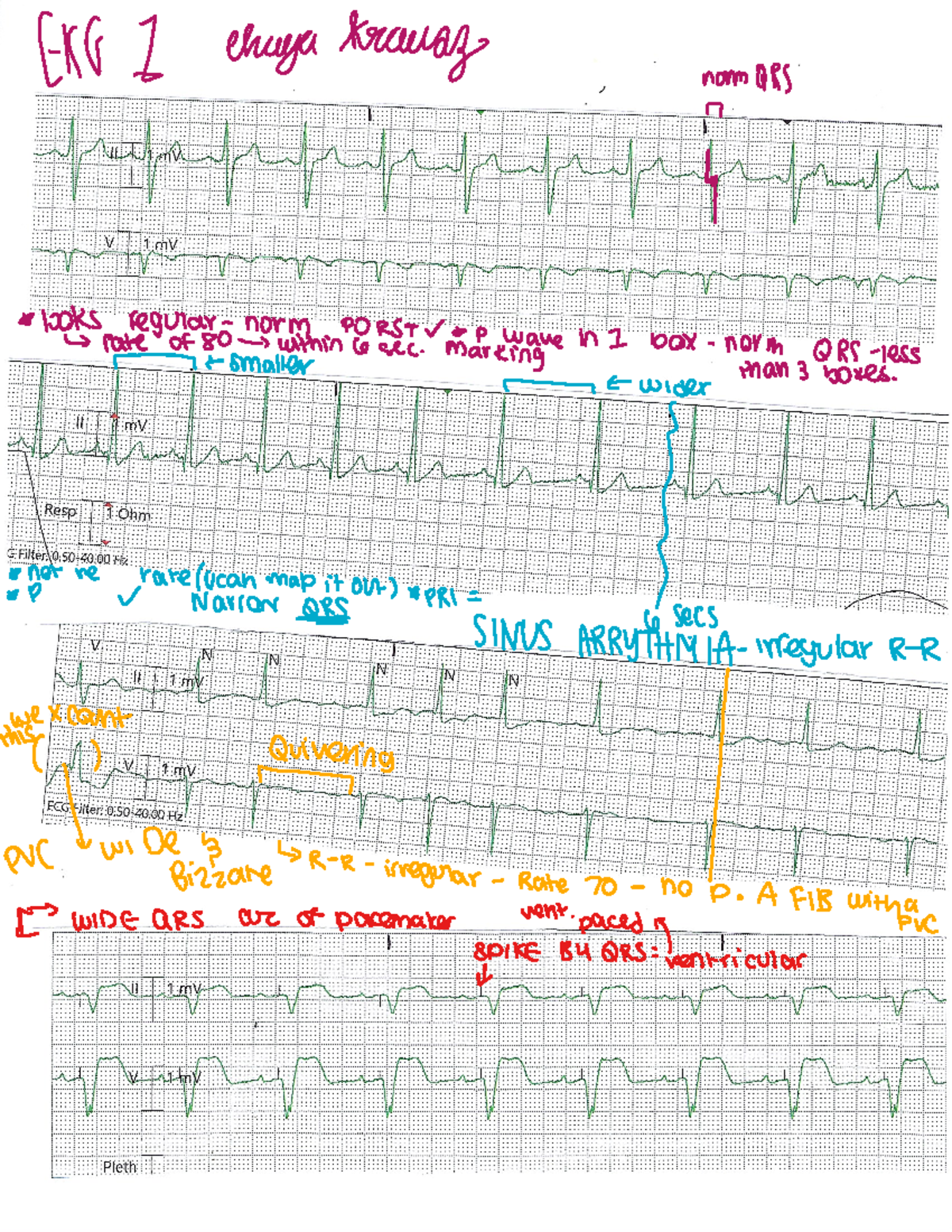 EKG I: Comprehensive Notes on Arrhythmias and Heart Blocks - Studocu