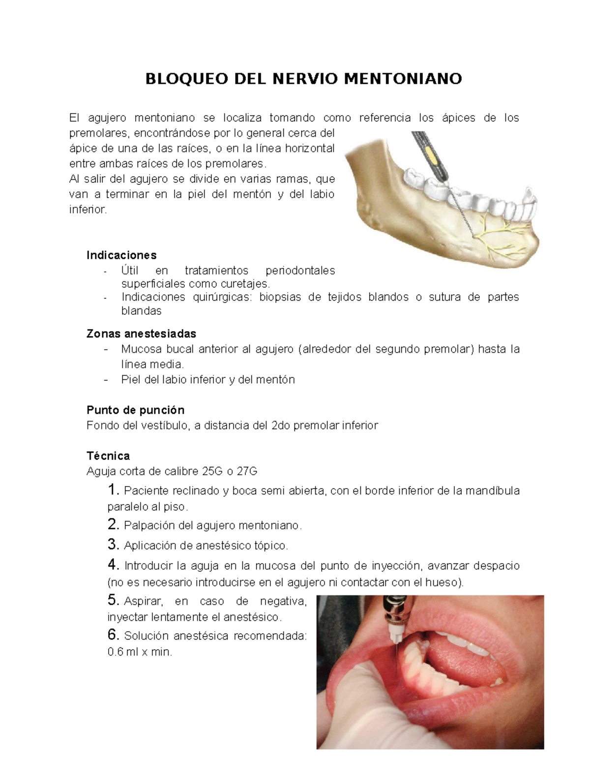 Técnica Mentoniana - BLOQUEO DEL NERVIO MENTONIANO El agujero ...