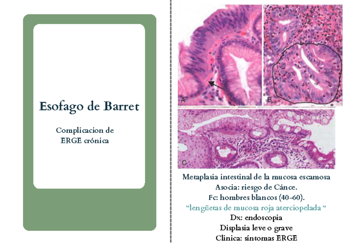 Esofago de Barrett y Complicaciones de ERGE: Estudio Integral - PATO 2º ...