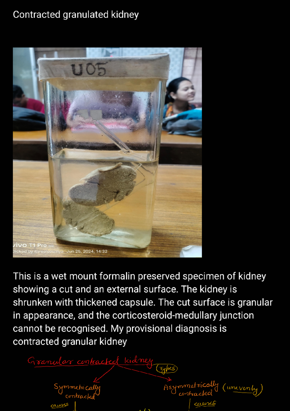 Gross specimen with topic discussion (pathology) - Contracted ...