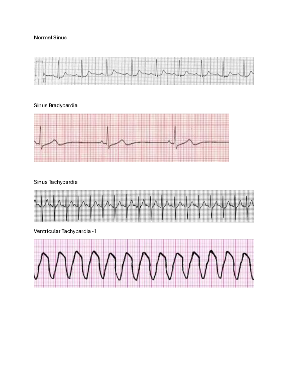 EKG Rhythms & Medications Quick Guide - Cardiac System Notes - Studocu
