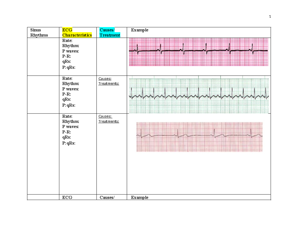 Student Rhythm Worksheet-SC - Sinus Rhythms ECG Characteristics Causes ...