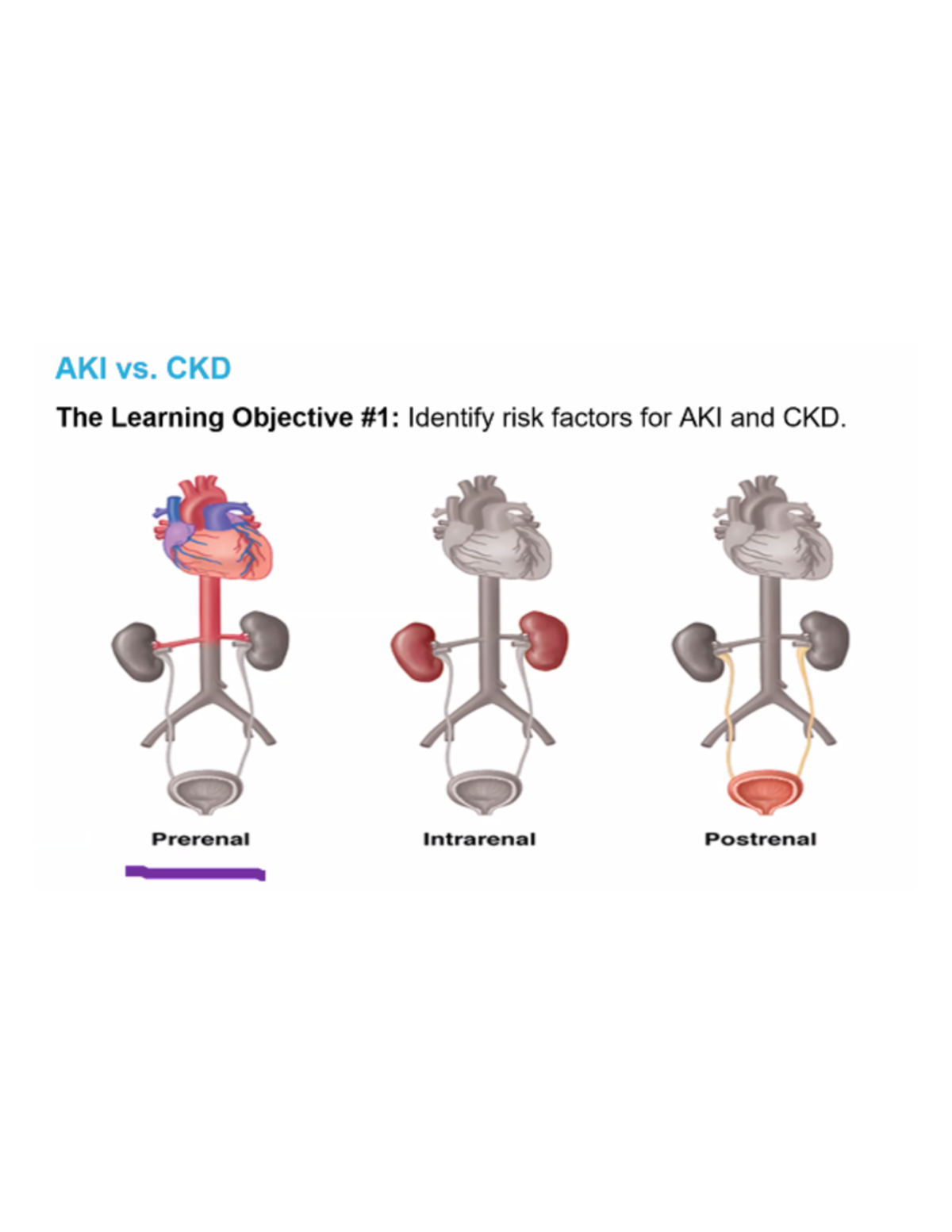Pre, Intra, & Post Renal - NURS 410 - AKI vs. CKD The Learning ...