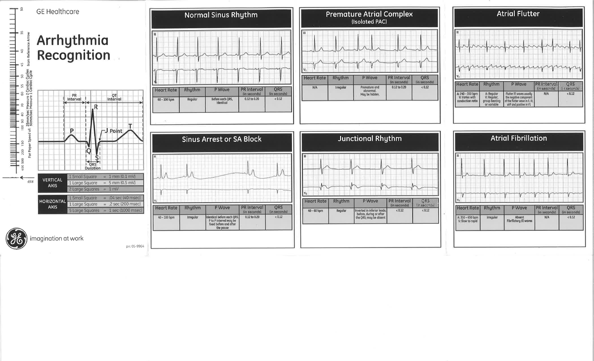 EKG Arrhythmia Recognition: Normal Sinus, PAC, & Atrial Flutter - Studocu