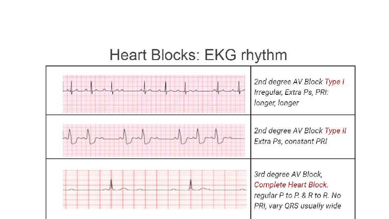 NEW ECG PART 2: Bradycardia & Heart Blocks - BLS Guidelines - Studocu