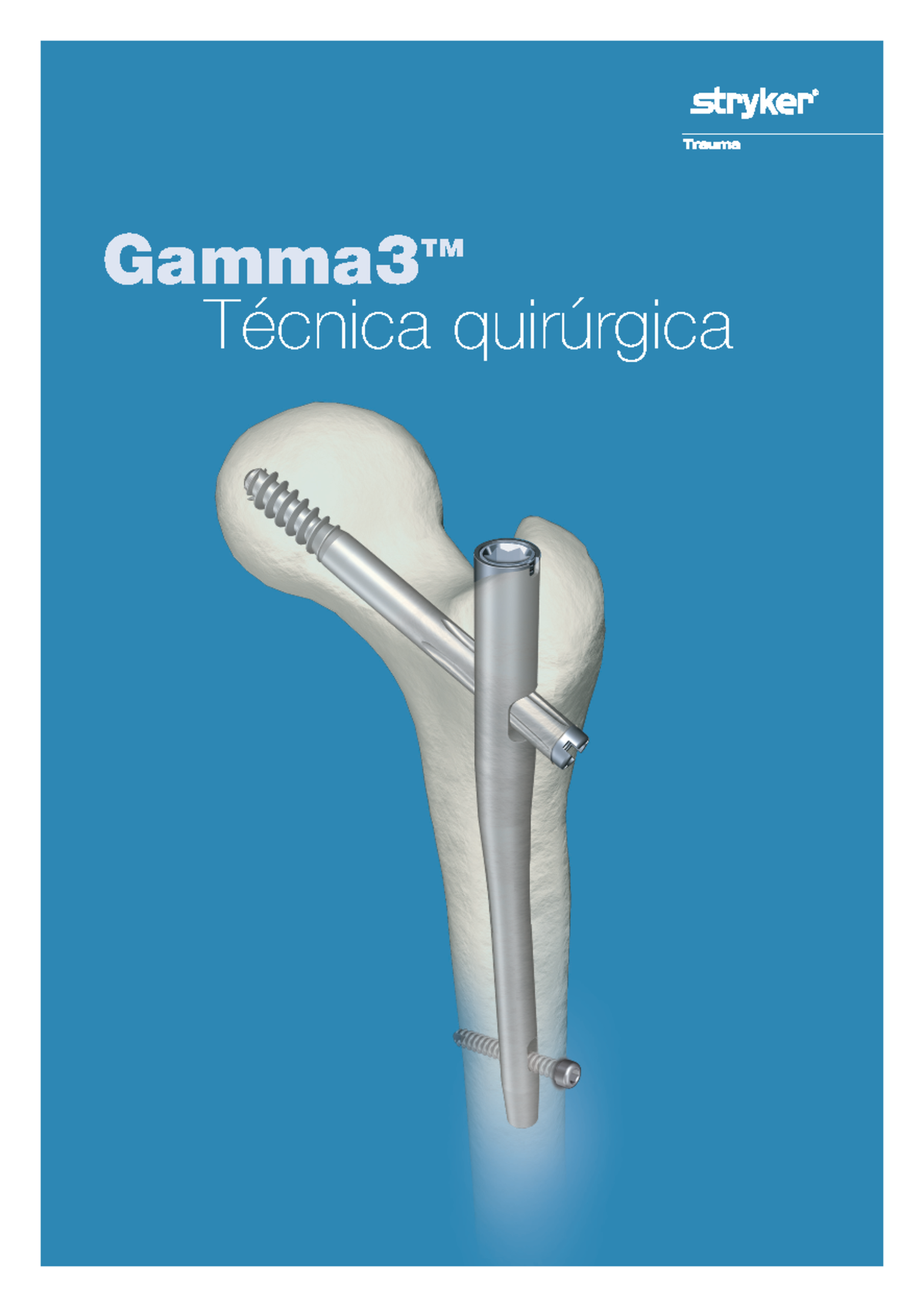 Colocación Quirúrgica del Clavo Gamma3 en Procedimientos de Ortopedia ...