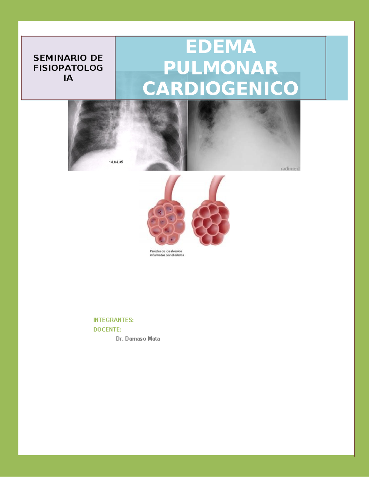 EDEMA PULMONAR CARDIOGÉNICO: FISIOPATOLOGÍA Y MANEJO - E.A.P. MEDICINA ...