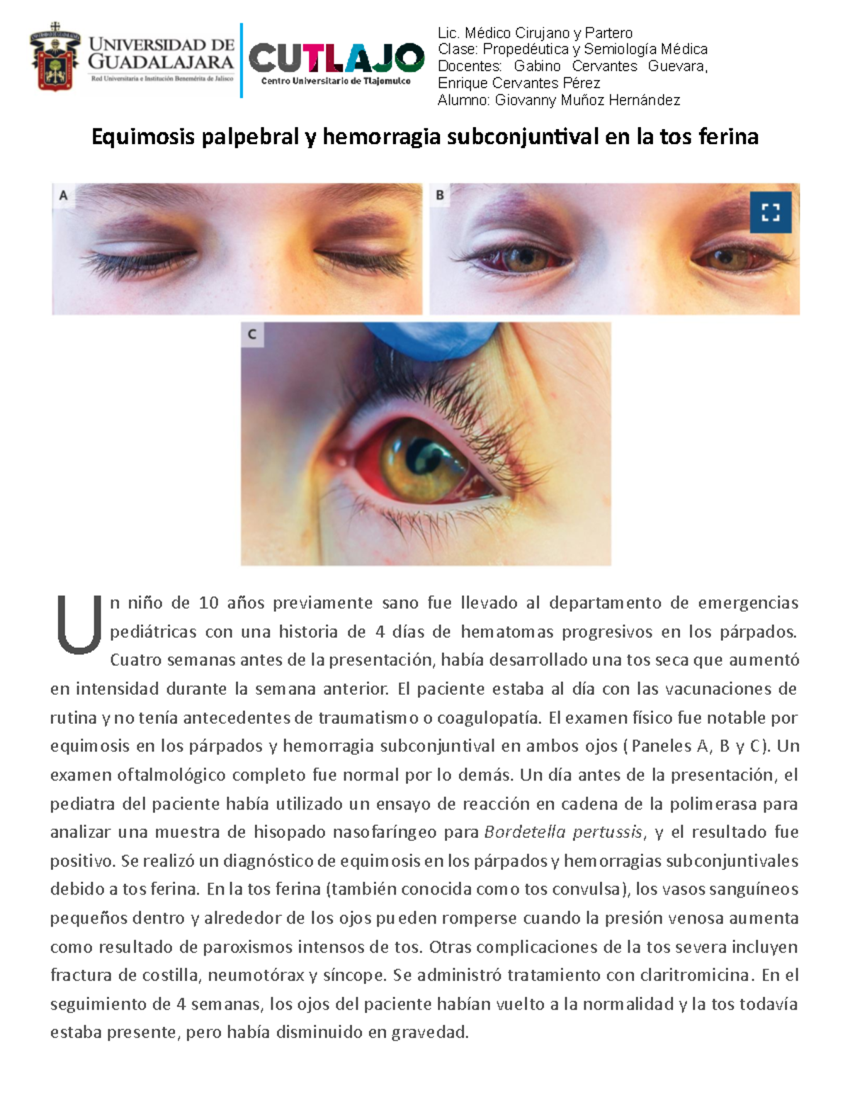 Equimosis Palpebral y Hemorragia Subconjuntival en Tos Ferina - Clase ...