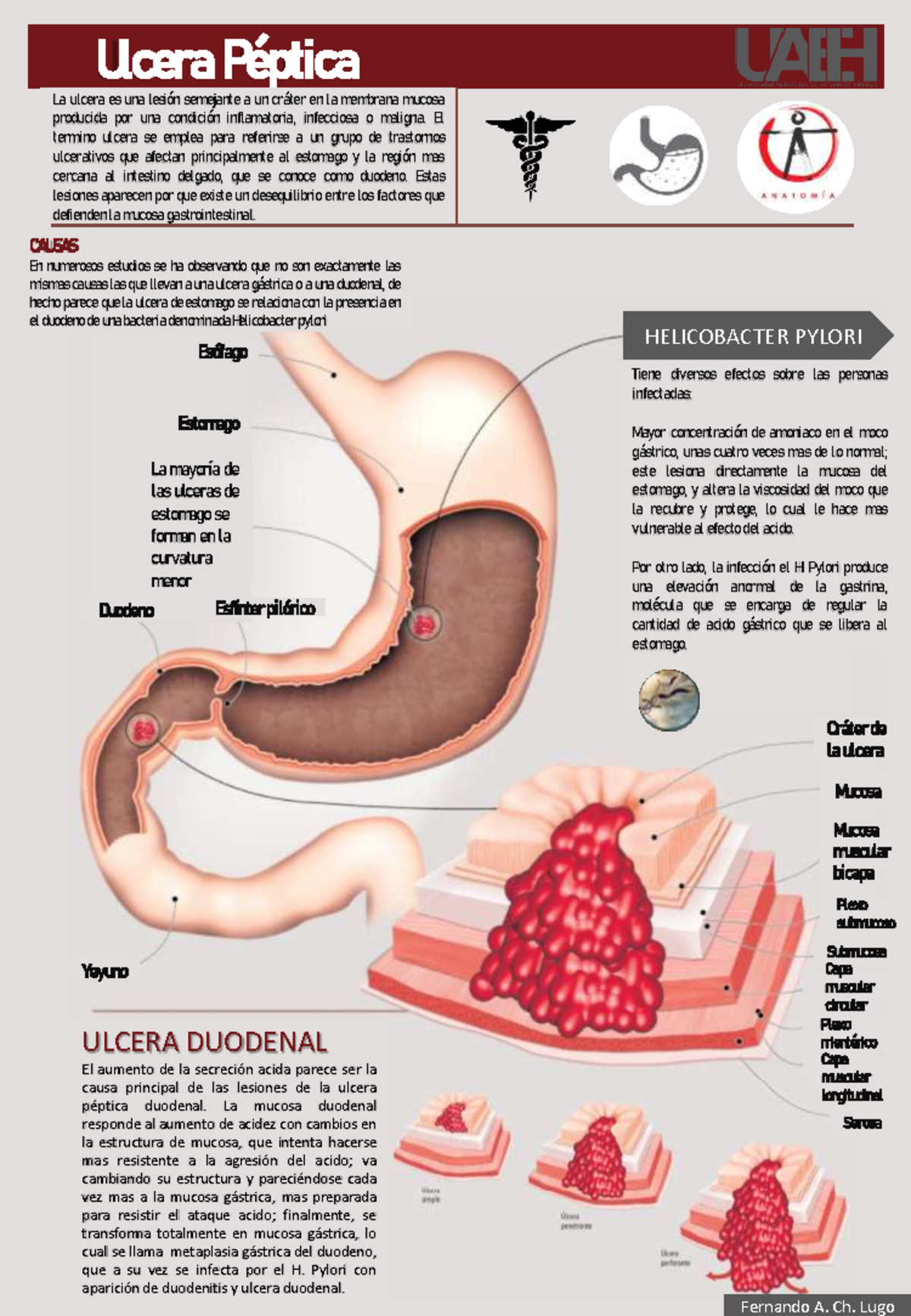 Anatomía De La úlcera Péptica