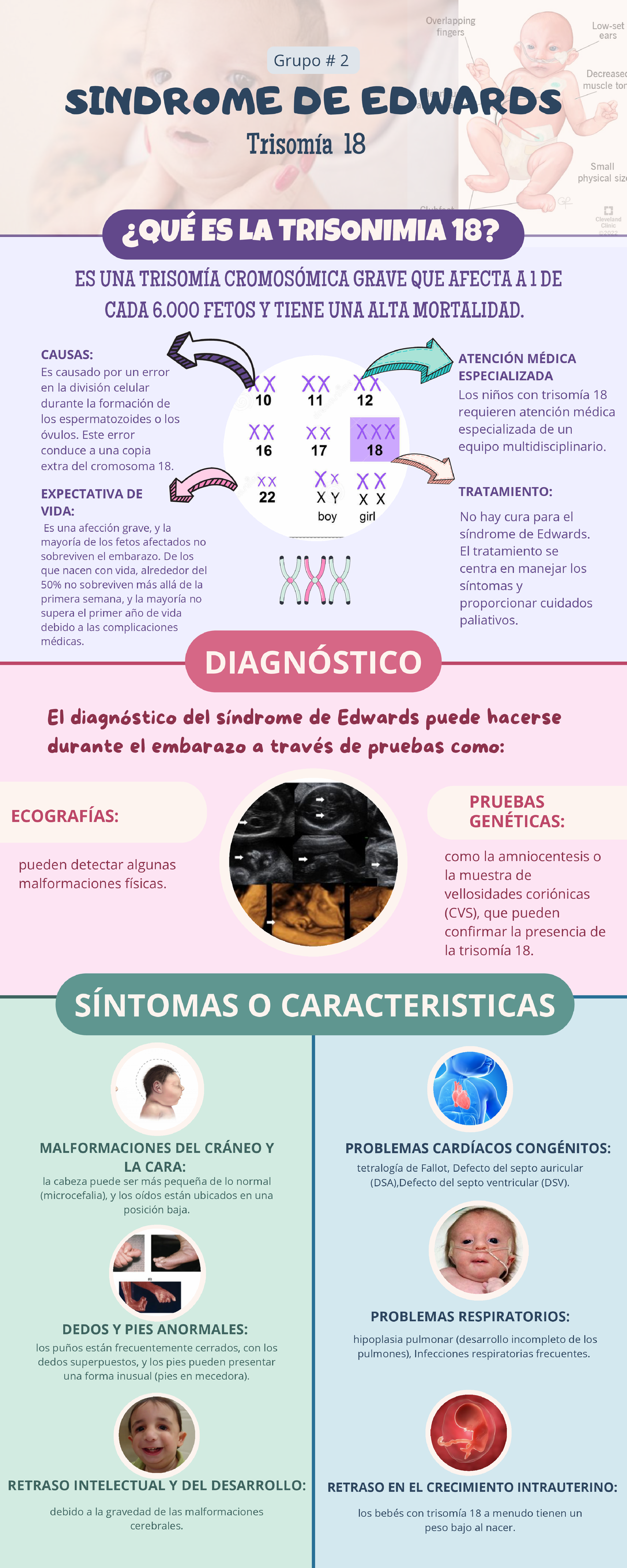 Síndrome de Edwards (trisomía 18) (1) - Overlapping fingers ears Grupo ...