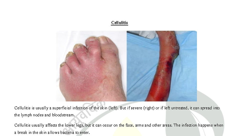 Cellulitis Overview: Symptoms, Diagnosis, and Treatment Insights - Studocu