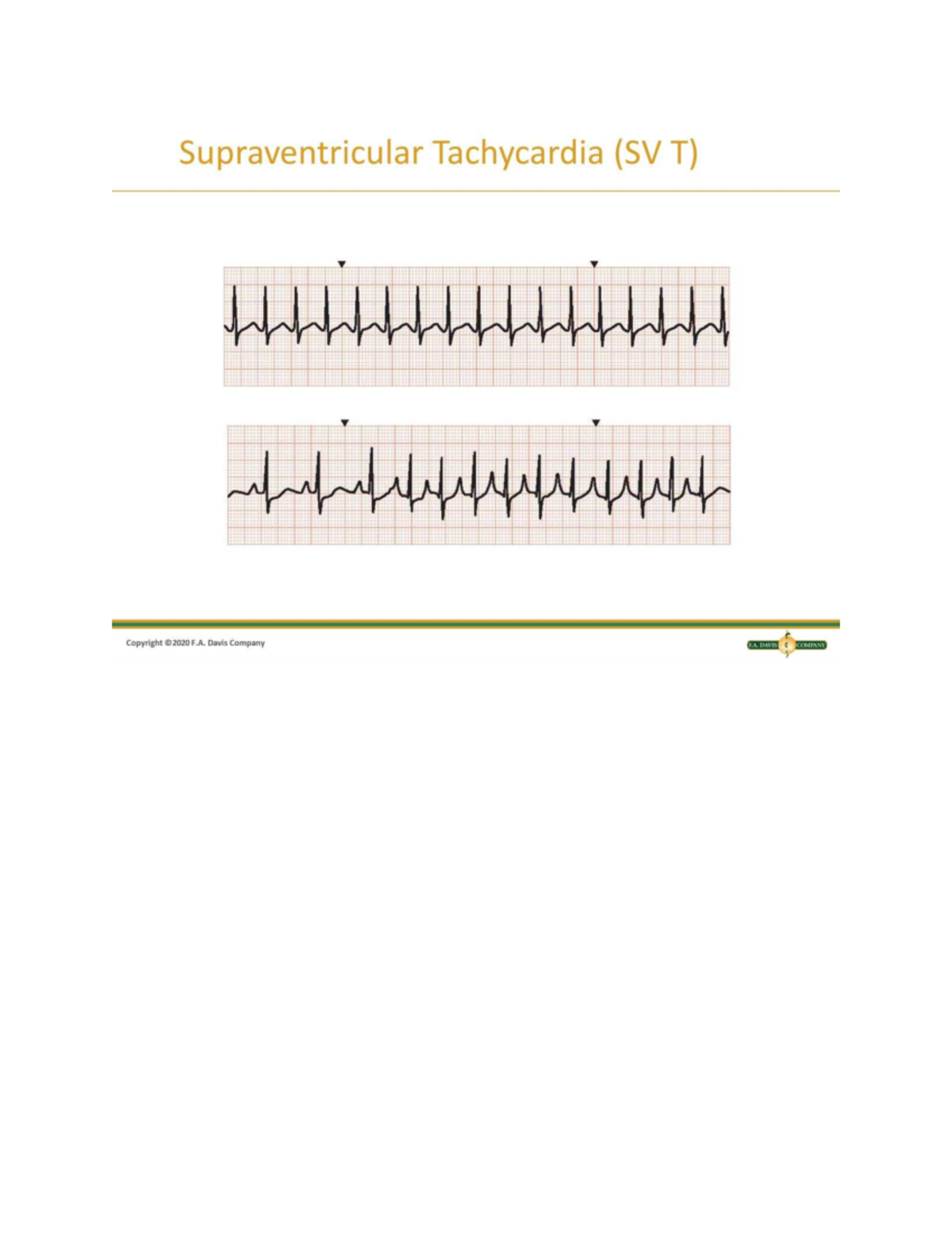 Cardiac Strips Analysis: Supraventricular & Ventricular Rhythms - Studocu