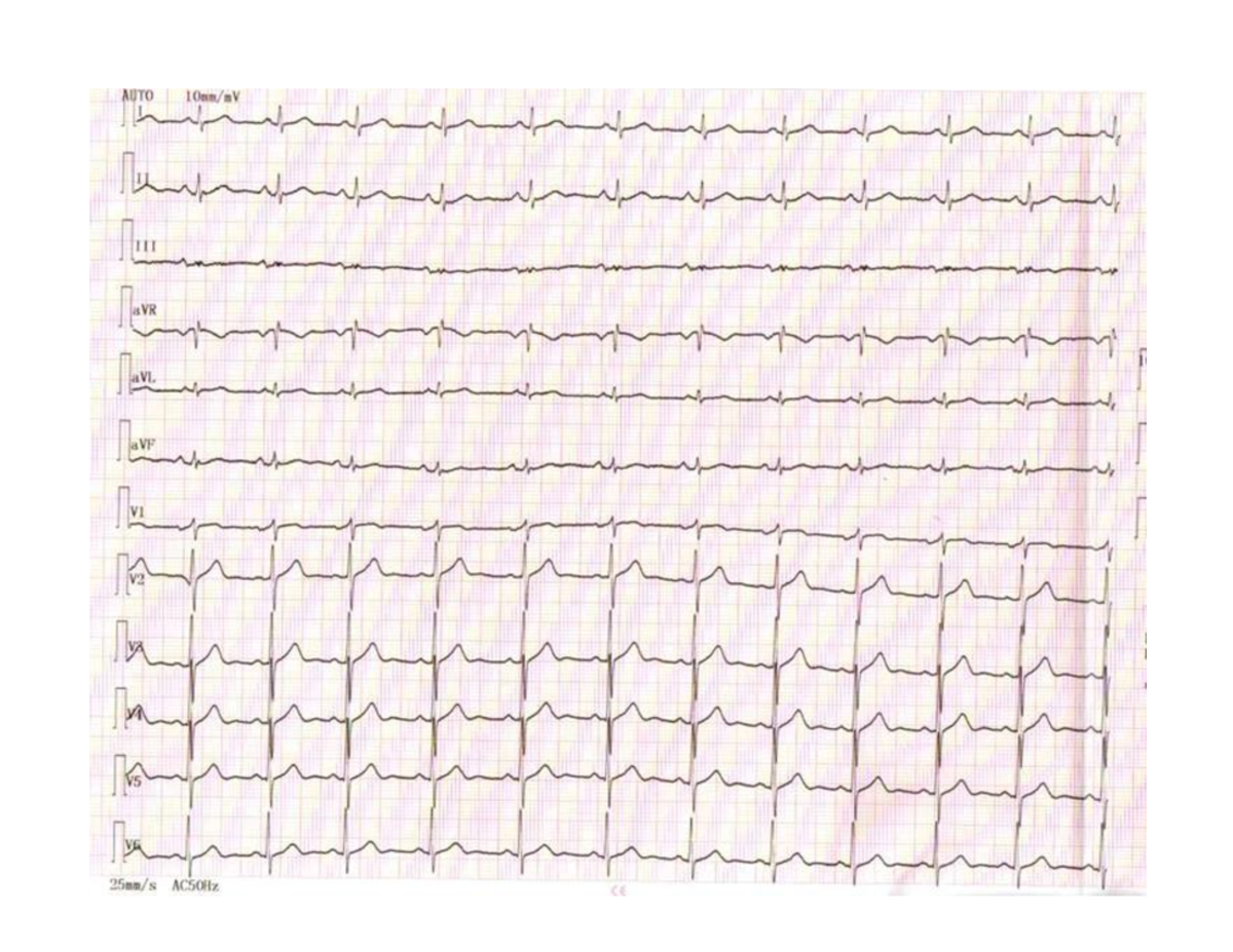 AUTO ECG Analysis - 10mm/mV Measurements and Interpretations - Studocu