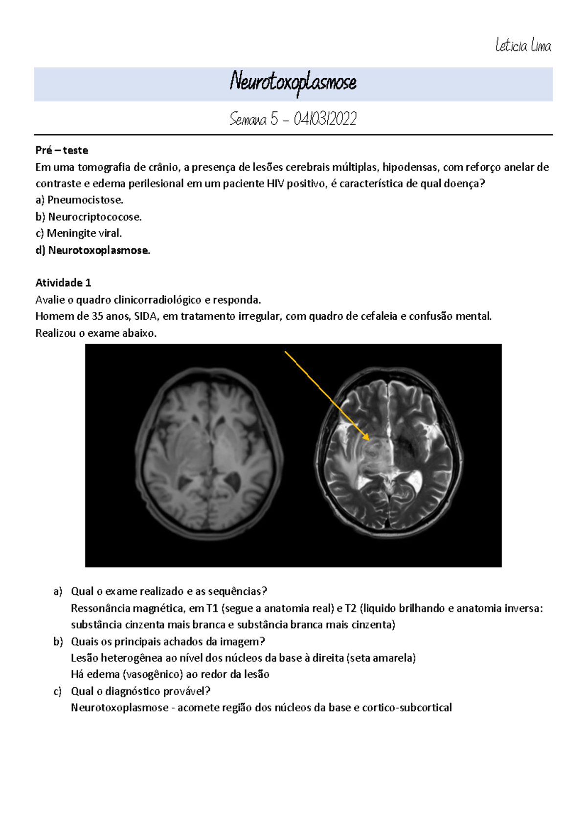 Neurotoxoplasmose e Imagens de TC: Entendendo o Diagnóstico - Studocu