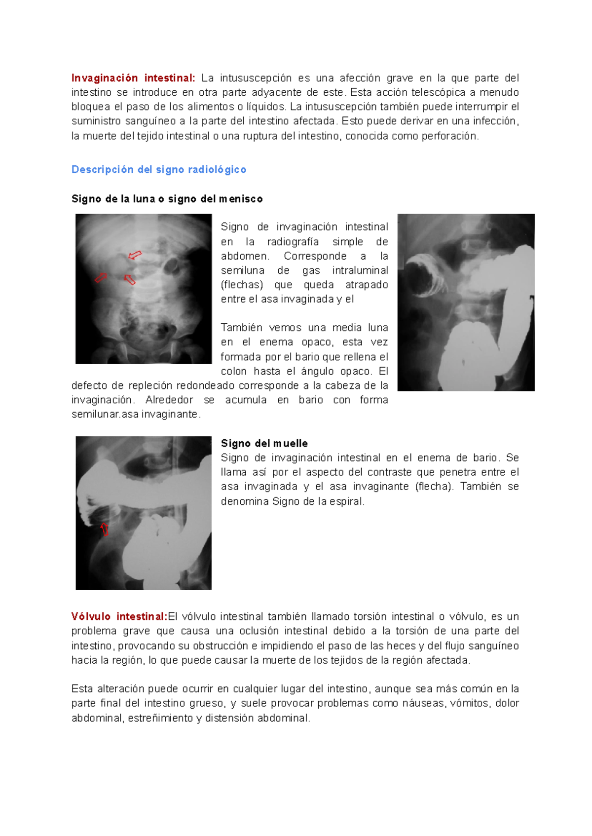 Signos Radiológicos de Intususcepción y Vólvulo Intestinal - Studocu