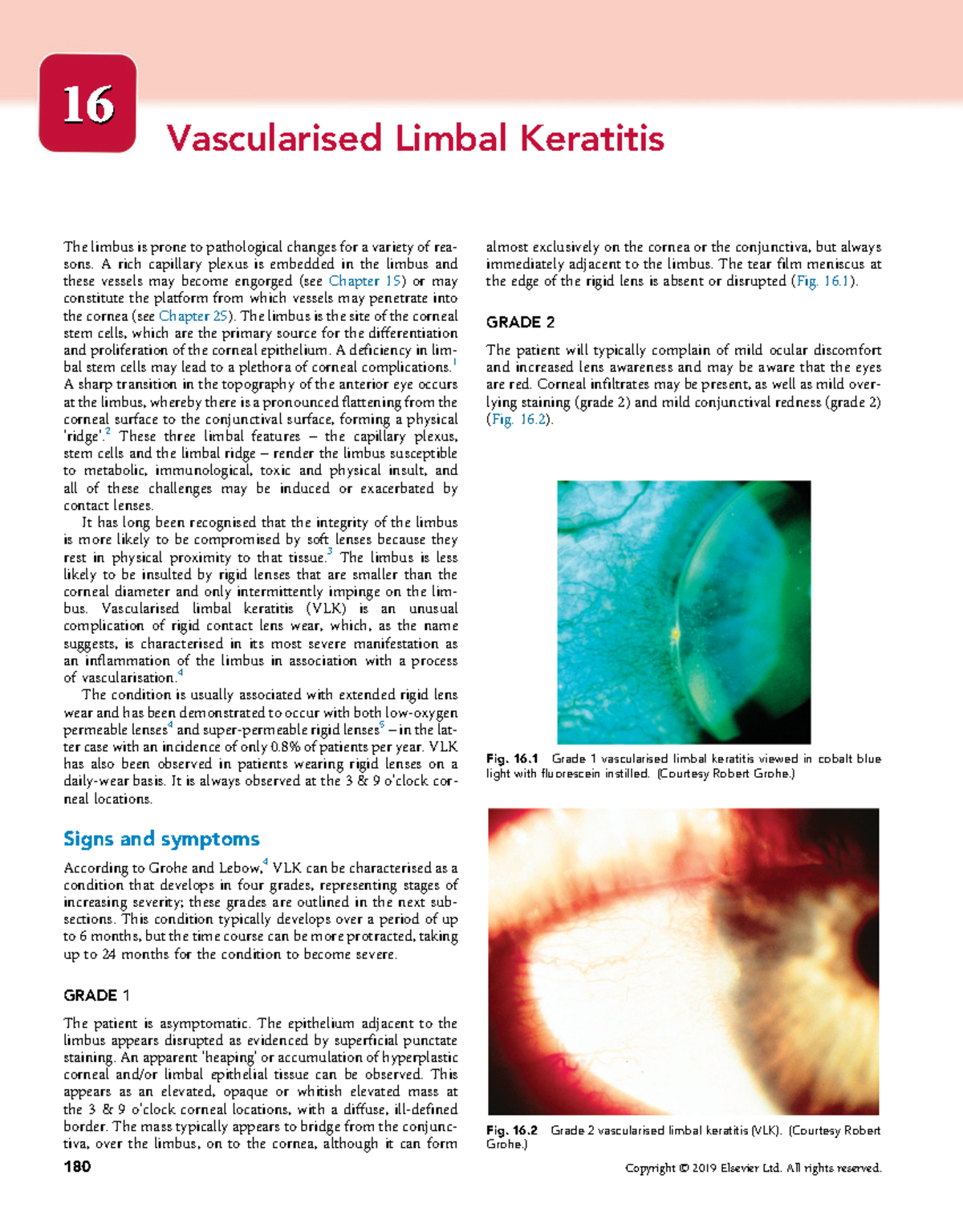 Vascularised Limbal Keratitis and Rigid Contact Lens Complications ...