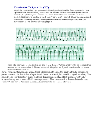 ECG reading materials with direct example for practice - The EKG on the ...