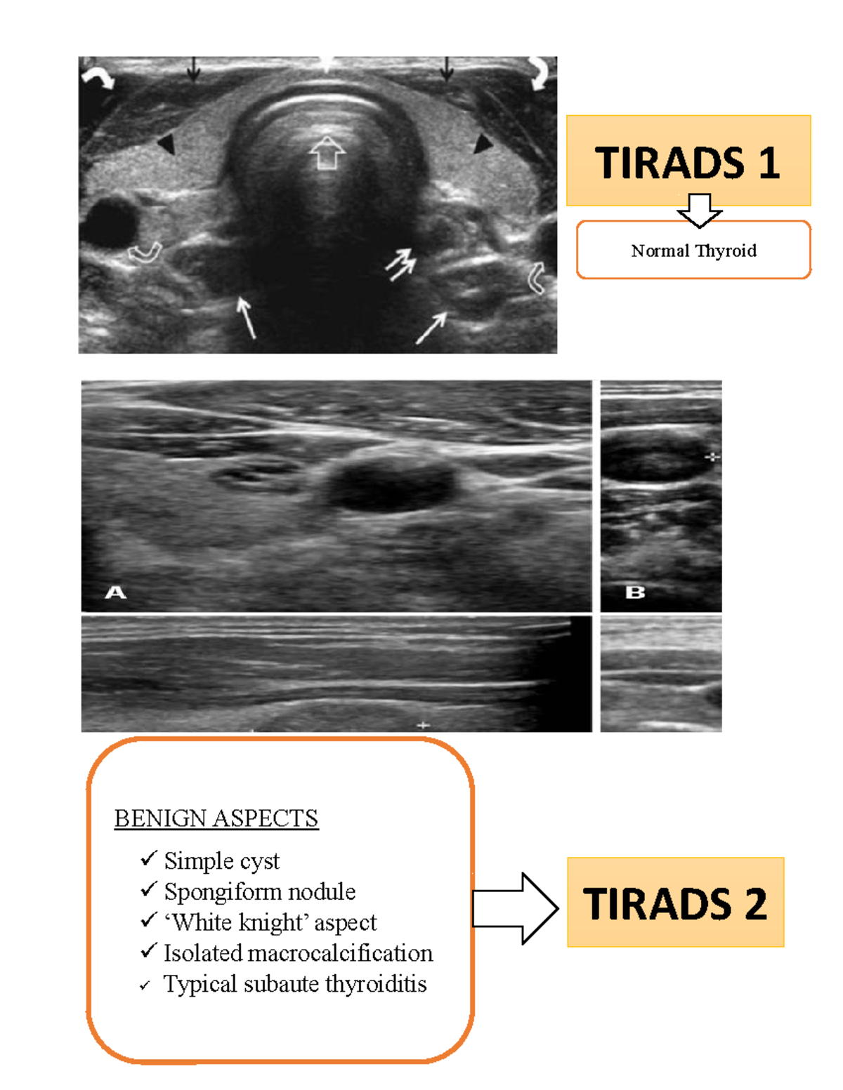 TIRADS Classification Overview: Key Aspects and Scoring Guide - Studocu