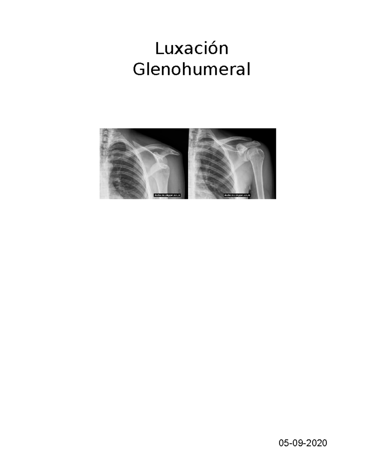 Luxación Glenohumeral: Causas y Factores de Riesgo - Studocu