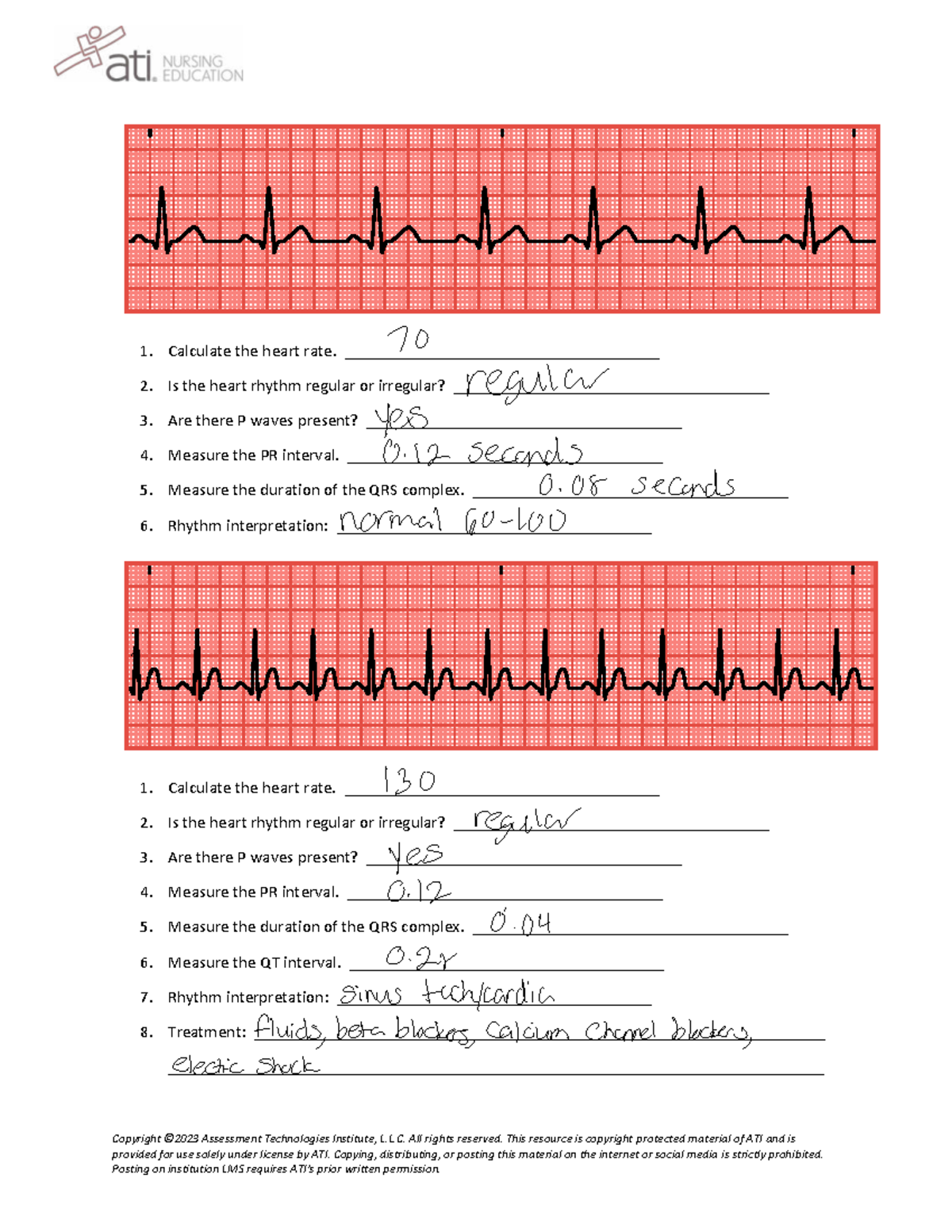 EKG Analysis and Rhythm Interpretation - EMG Study Guide - Studocu