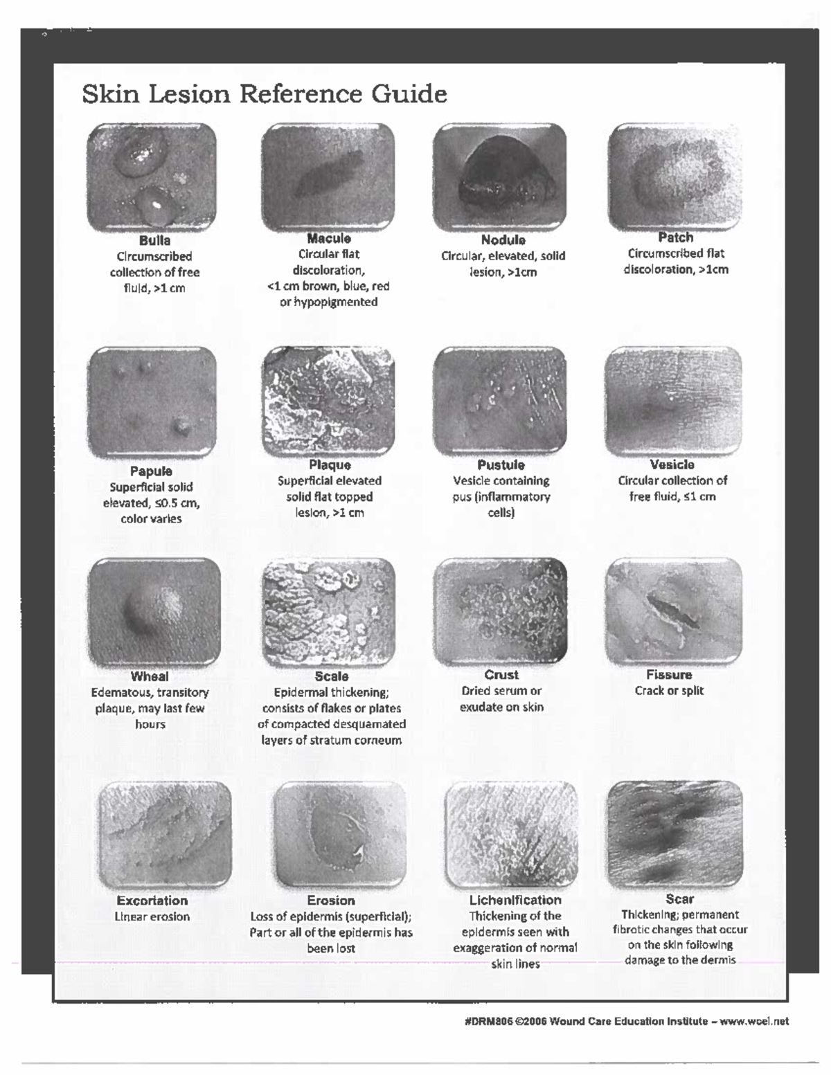 Skin Lesion Reference Guide: Types and Descriptions for Wound Care ...
