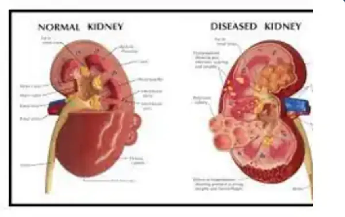 ESRD - Comprehensive Concept Map for End Stage Renal Failure Management ...